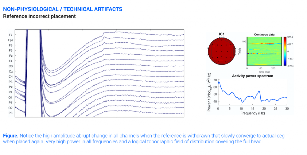 All about EEG Artifacts and filtering tools | Bitbrain