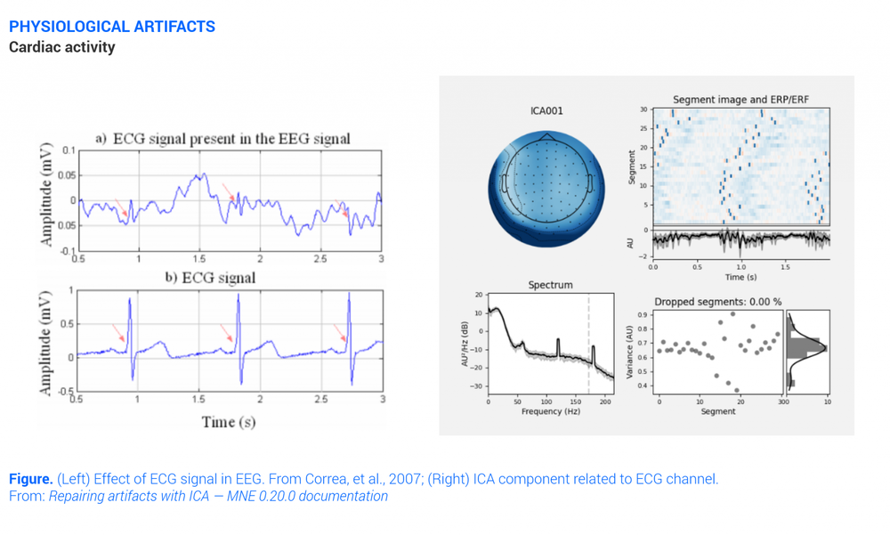 All about EEG Artifacts and filtering tools | Bitbrain